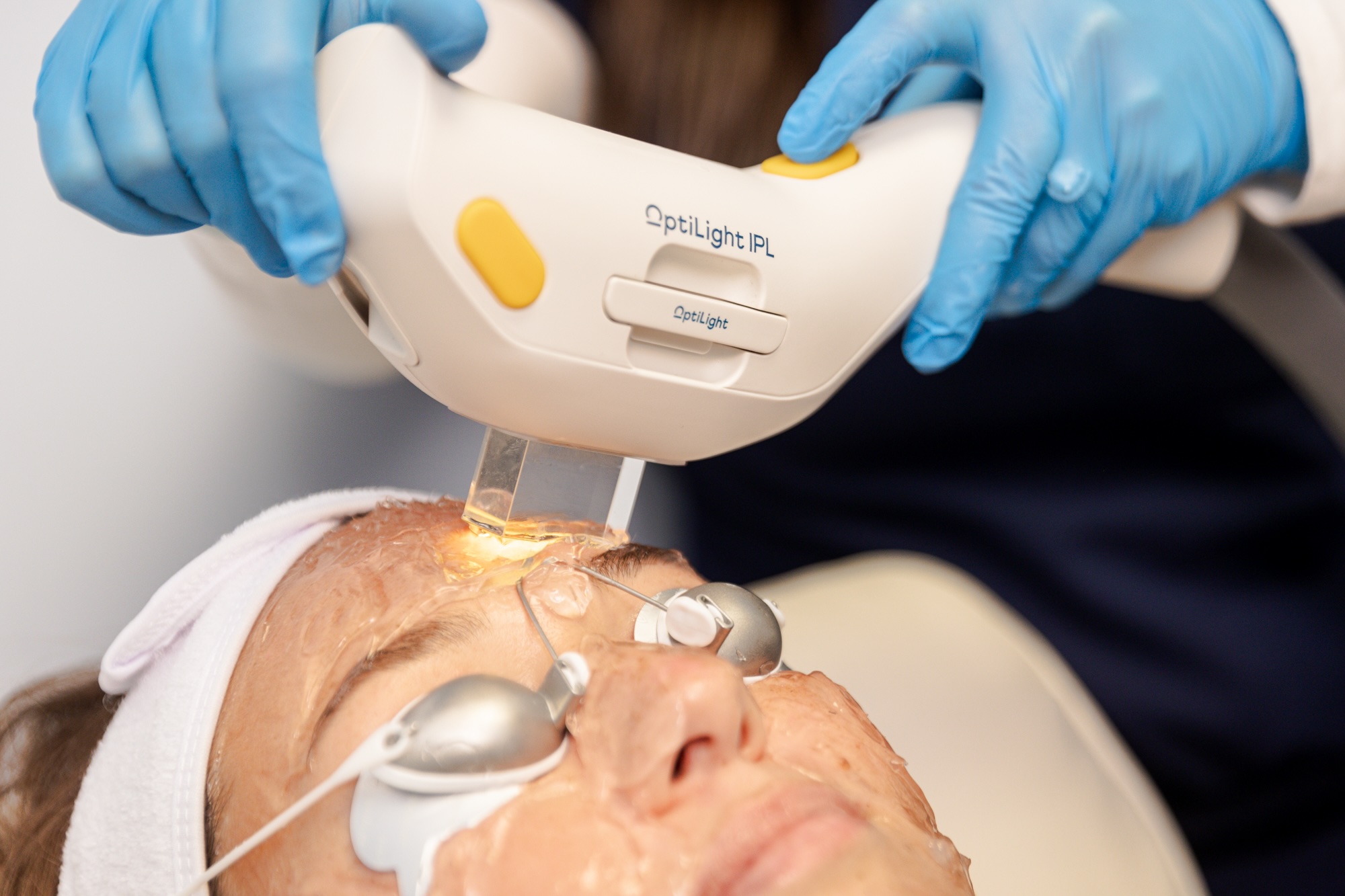 Hyperpigmentation Treatment in Mankato, MN | The Skin Clinic Med Spa